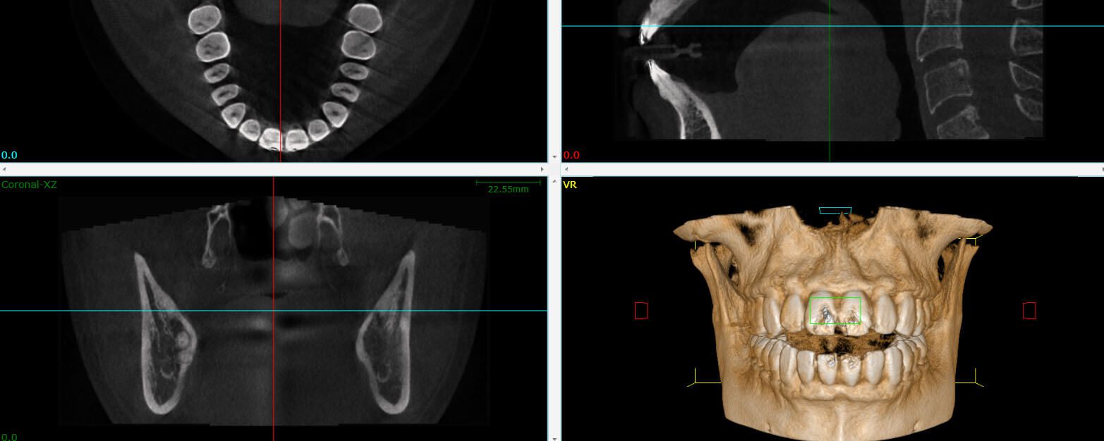 Cone Beam 3D Imaging – Whitby Endodontics